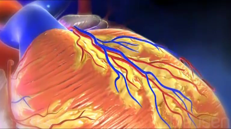 Infarctus du myocarde - animation - HUG