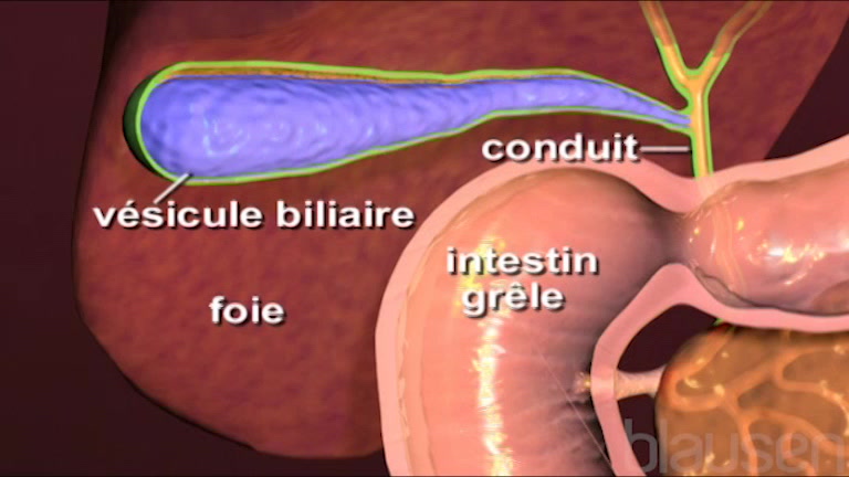 Ablation de la vésicule biliaire - HUG