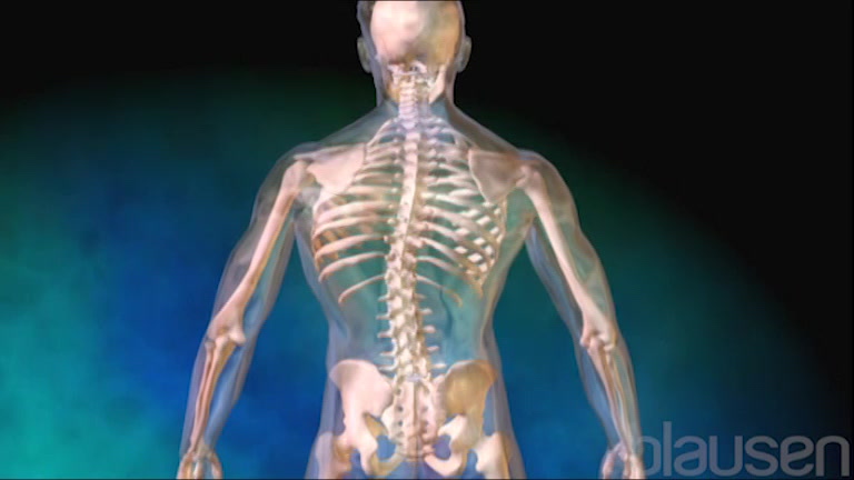 Spondylodèse - animation - HUG
