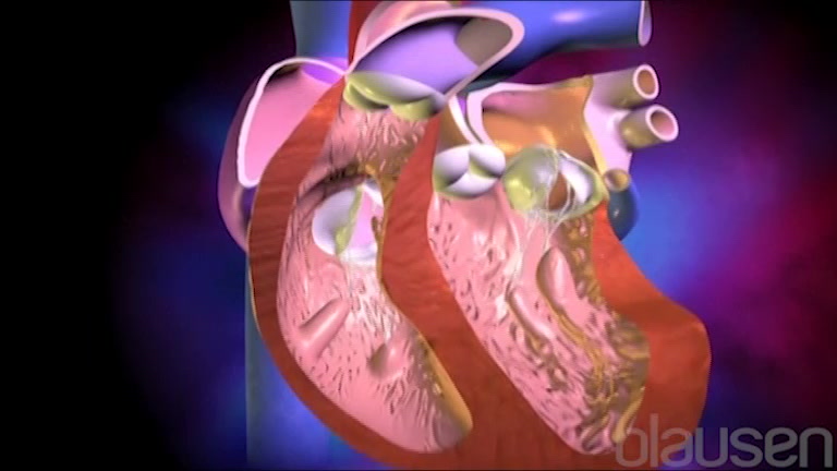 Sténose de la valvule mitrale - HUG