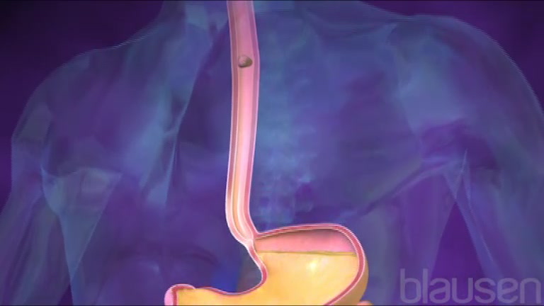 Incontinence fécale - HUG