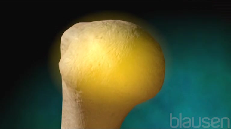 Périarthrite scapulo-humérale - HUG