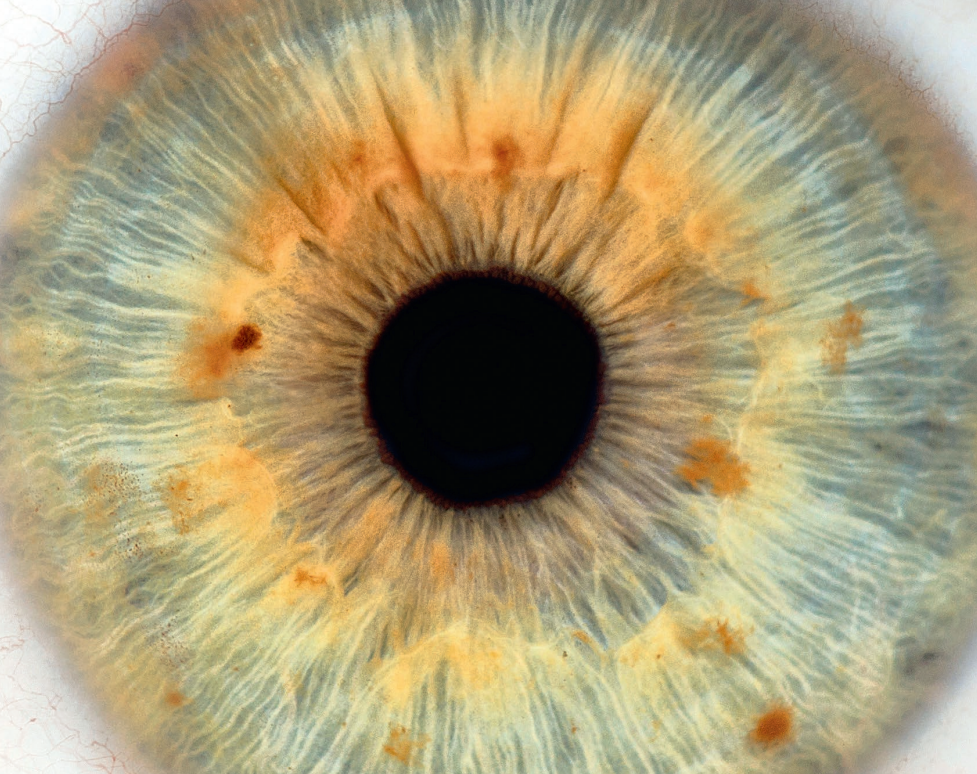 Le glaucome et ses traitements - HUG