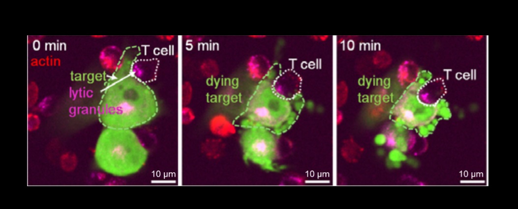 Customised cells to fight brain cancer - HUG