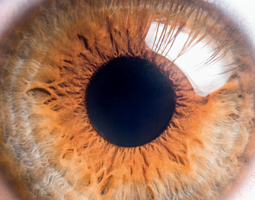 Le ptérygion - Service d'ophtalmologie | HUG - Hôpitaux Universitaires ...