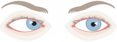 Quelles sont les formes de strabisme? Service d'ophtalmologie | HUG ...